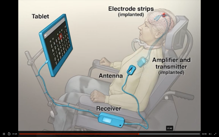 Fully implanted brain-computer interface in a locked-in patient with ... Fully implanted brain-computer interface in a locked-in patient with ...